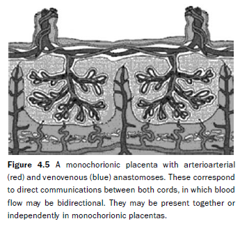 Placenta | Twin-Twin Transfusion Syndrome (TTTS)