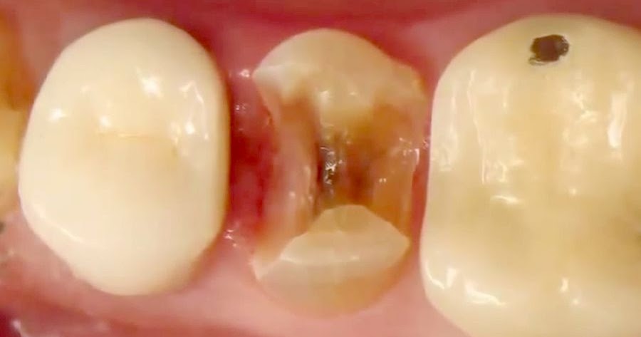 COMPOSITE RESTORATION: Indirect/Direct Composite Inlays - Odonto-Tv