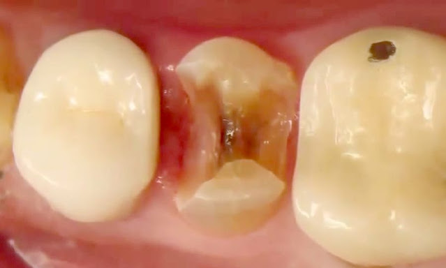 COMPOSITE RESTORATION: Indirect/Direct Composite Inlays - Jose-Luis Ruiz