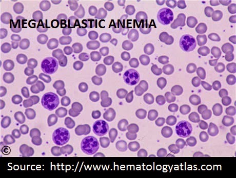 Lab Atlas: Megaloblastic Anemia