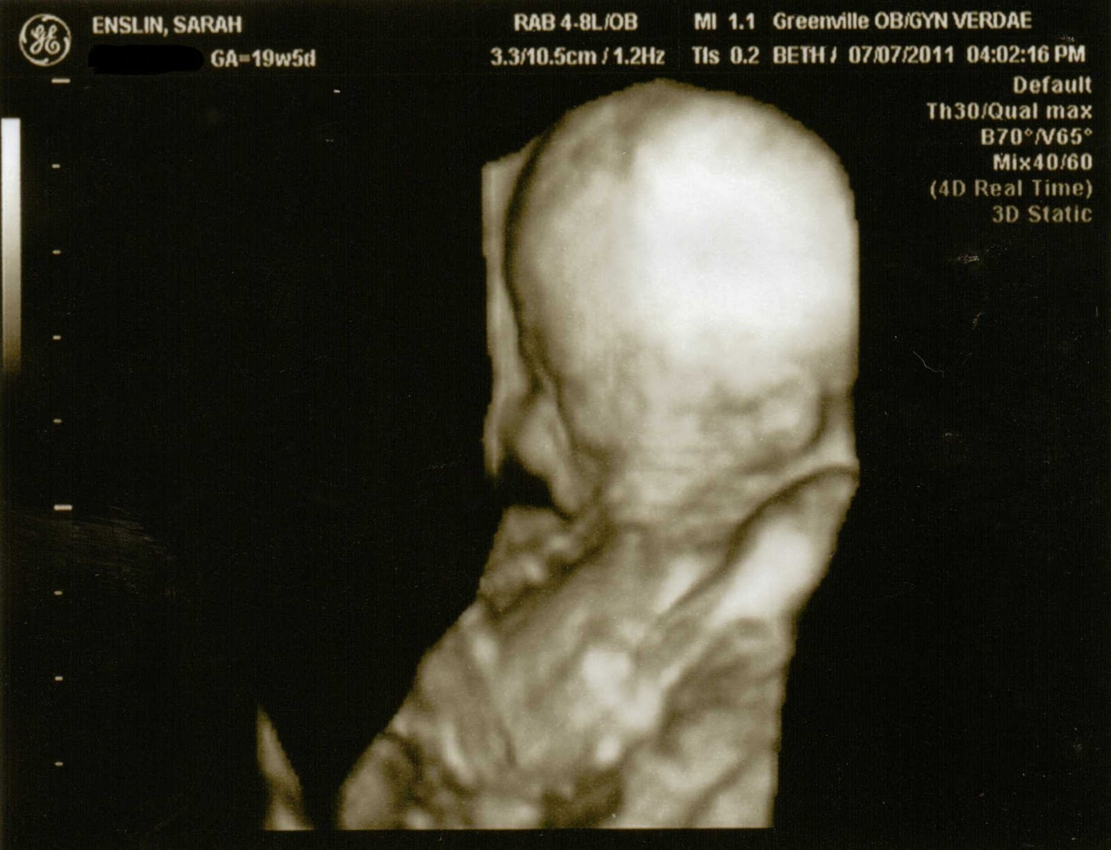 Waiting for Baby Grace: The "Official" gender ultrasound 19 weeks 5 ...