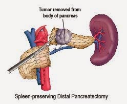 Distal Pancreatectomy – Pancreatic Surgery, when Pancreas Tail and Body ...