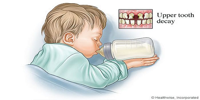 What is baby bottle tooth decay? Causes - OdontoVida