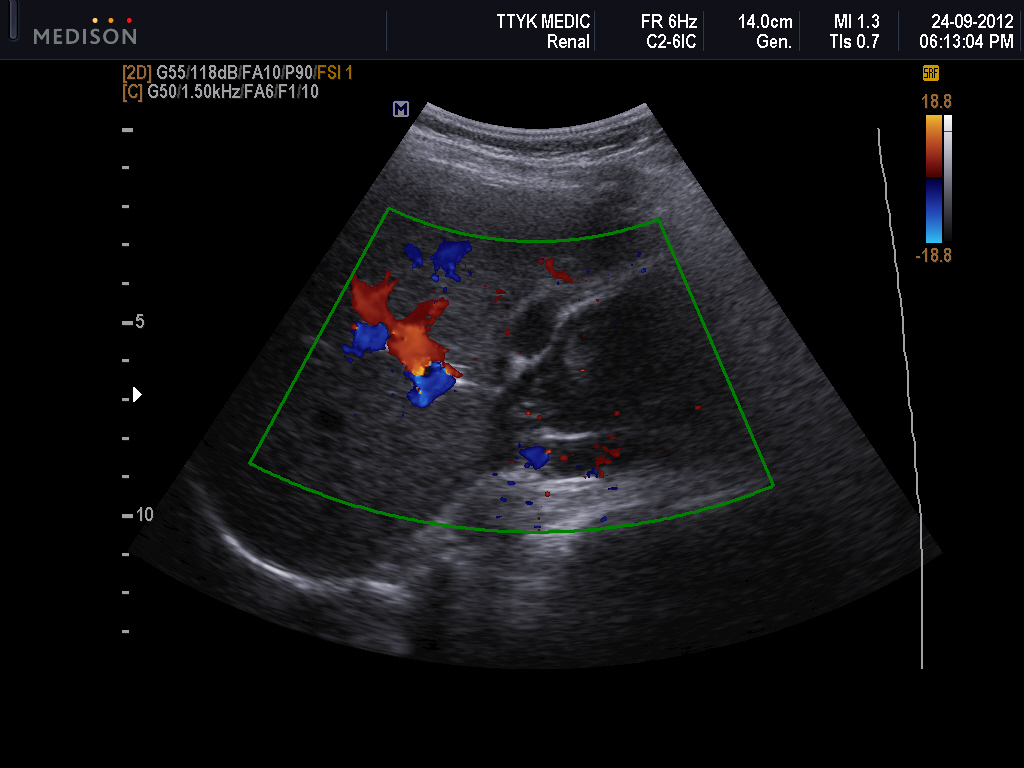 VIETNAMESE MEDIC ULTRASOUND: CASE 141: RUPTURE of DUODENUM, Dr PHAN ...