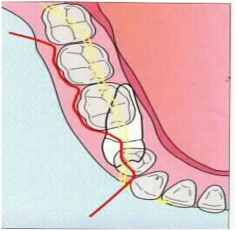 Dentistry and Medicine: Surgical management of Unerupted and Impacted teeth