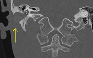 Aural Polyp- CT - Sumer's Radiology Blog