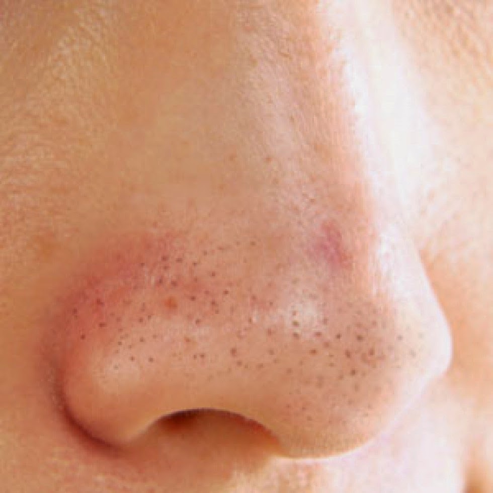 Rifa Facial: Tips Menghilangkan Komedo Membandel | Cara ampuh mengatasi ...