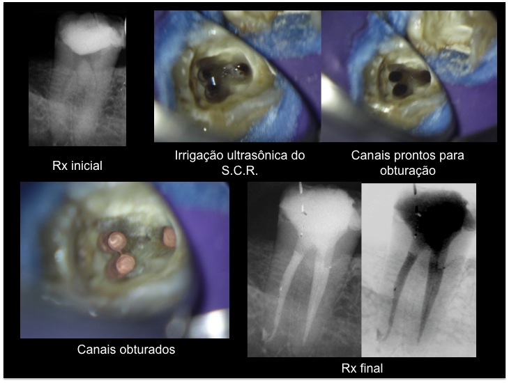 Davini - Endodontia e Microscopia Operatória: Tratamento endodôntico ...