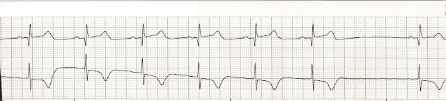 EKG Rhythm Strips 60