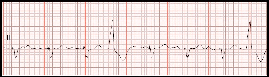 Practice EKG Rhythm Strips 161