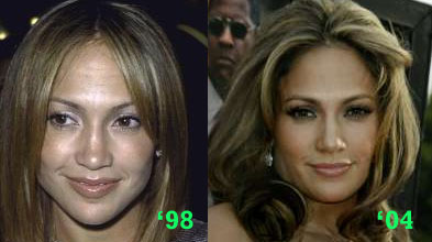 Jennifer Lopez Plastic Surgery Before and After Botox Injections ...