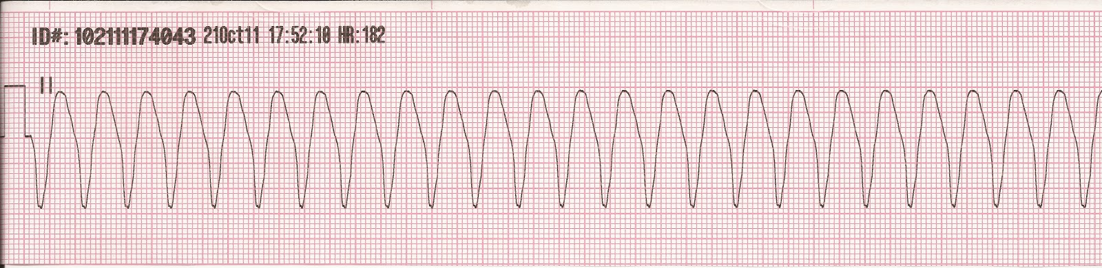 Basic ECG Rhythms