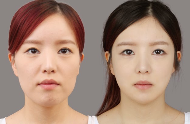 Apa sih itu operasi pengurangan rahang persegi???