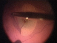 Saiba mais sobre a cirurgia de buraco macular - Portal da Oftalmologia