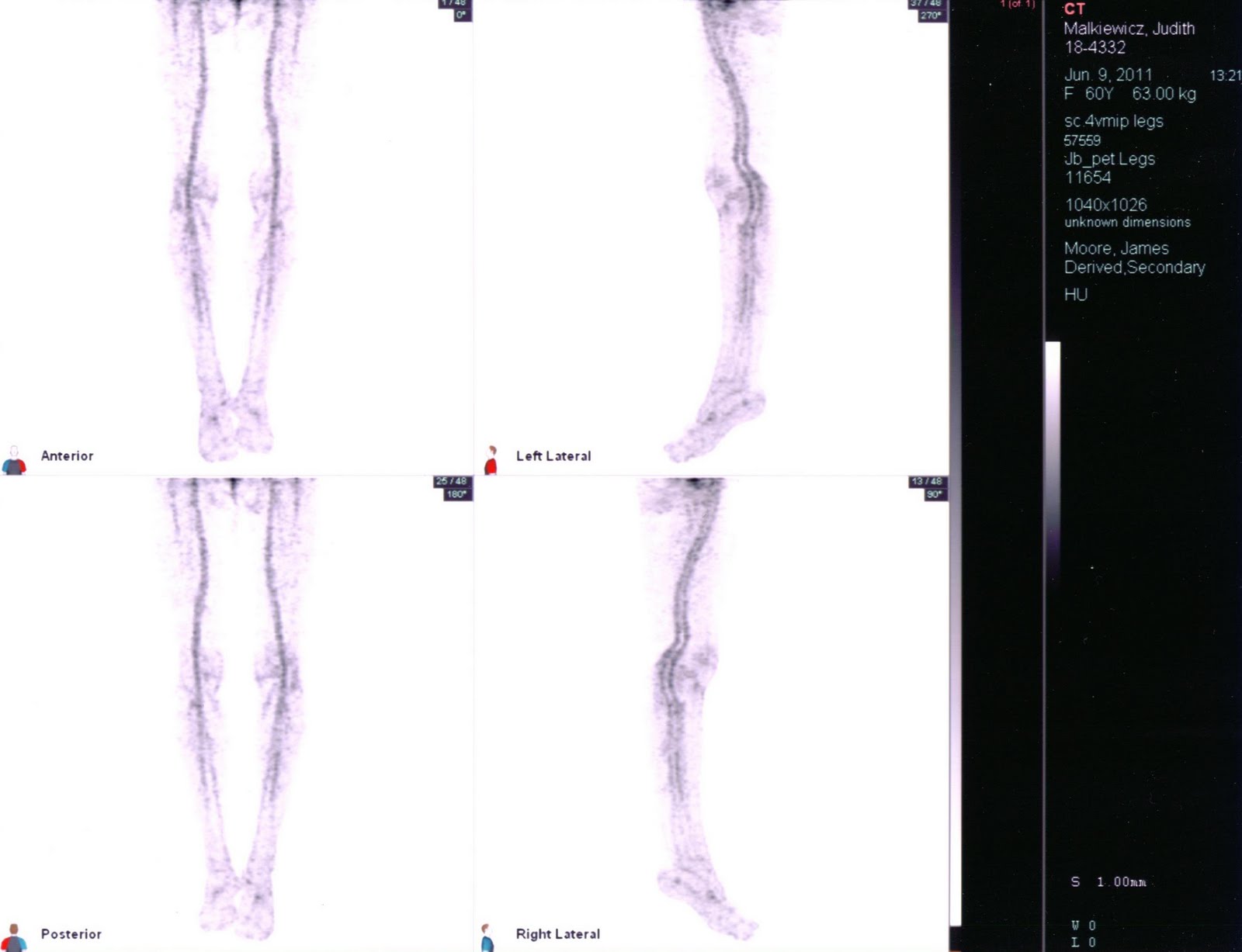 jm's Adventure with Multiple Myeloma: Dr. Moore Appointment and PET ...