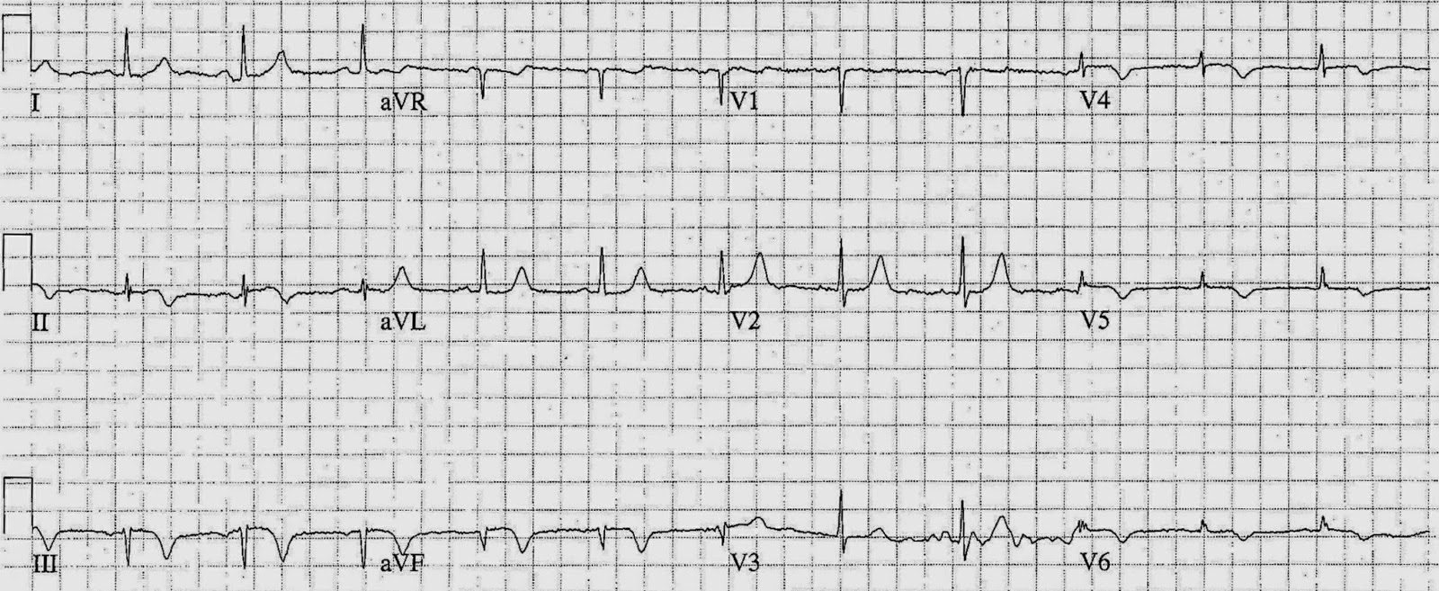 ECG of the Week: ECG of the Week - 21st October 2013 - Interpretation