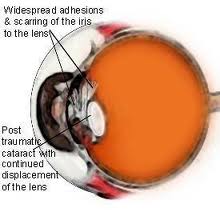 Safety Tools and Equipment Singapore: Eye Injuries (Part II)