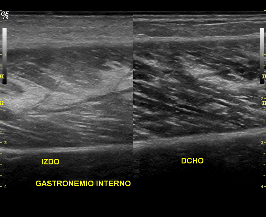 Reumails. Reumatología al día: Miositis focal vs Miositis nodular
