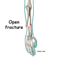 Medical Science: Open fracture and gustillo classification