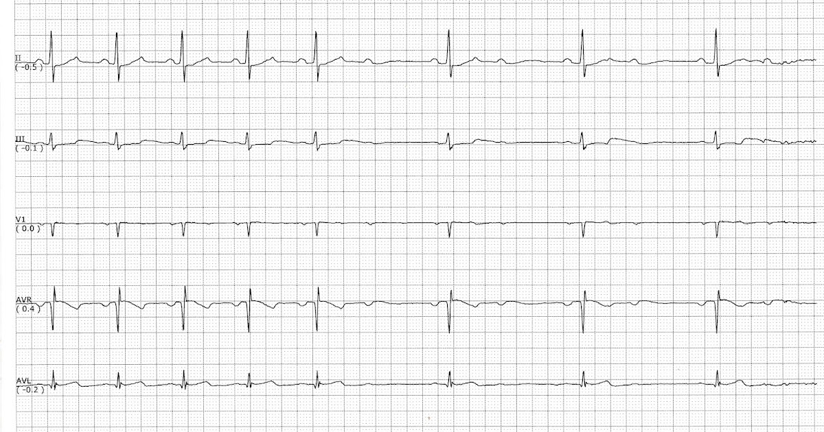 2nd Degree Heart Block Type II