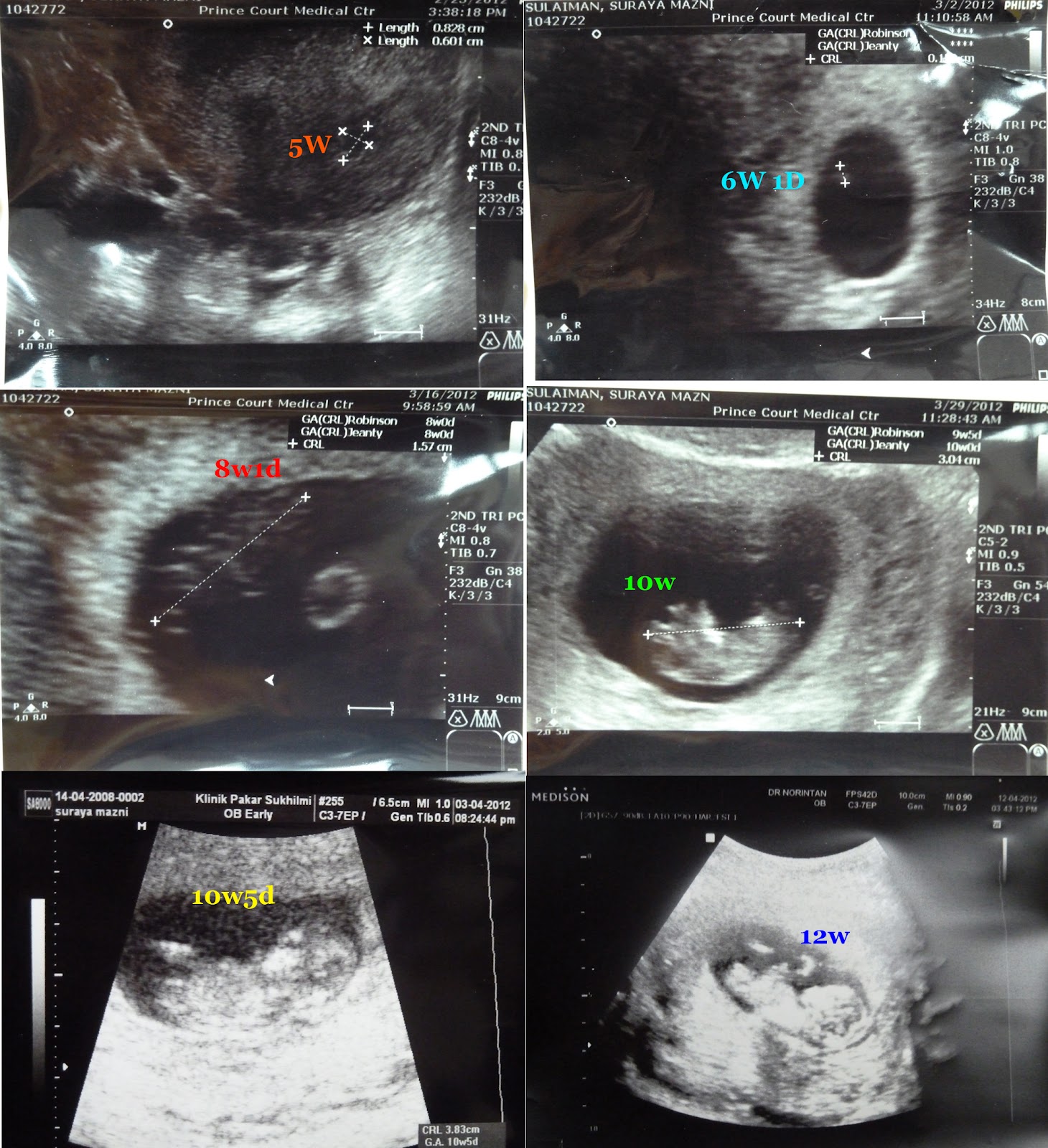 Mekchu Situ Sana Sini: 13 minggu tapi dah ada 6 gambar scan, ehh 7 ...