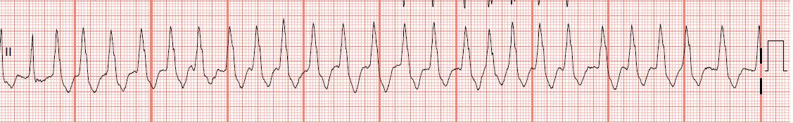 EKG Rhythm Strips 36