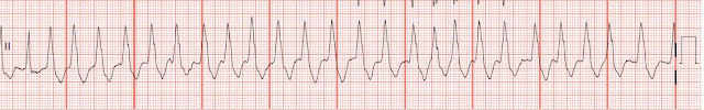 EKG Rhythm Strips 36