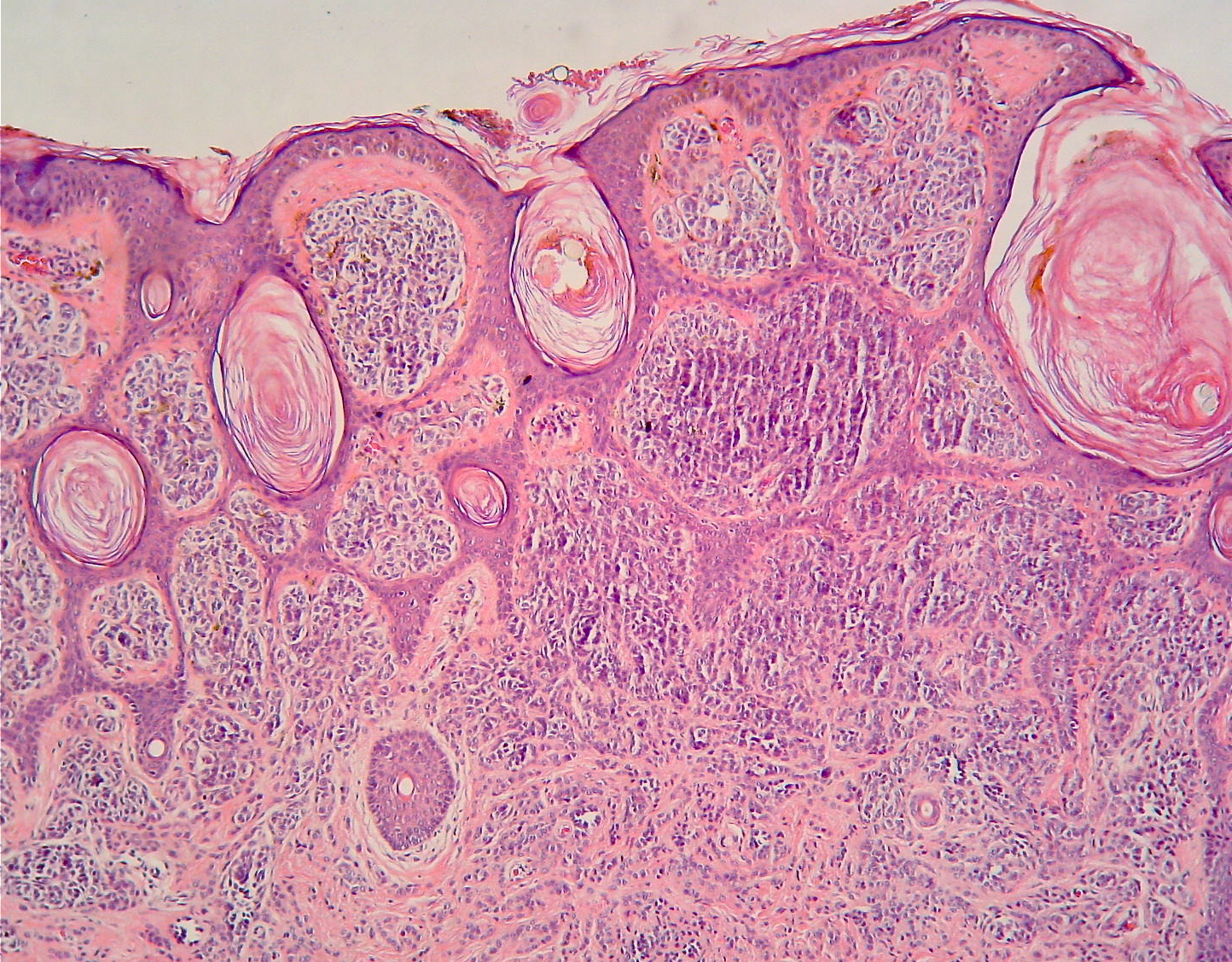 dermatopatologia para iniciantes: NEVOS MELANOCÍTICOS USUAIS