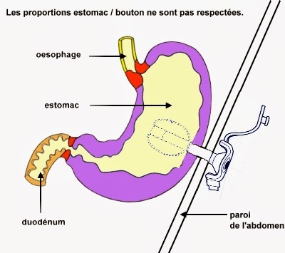 Informidel: CAS PRATIQUES DE COTATION D’ACTES INFIRMIERS : Cas N°3 ...