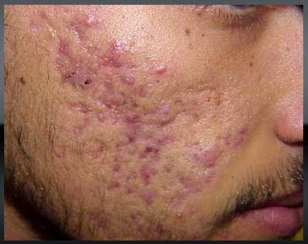 EPÓNIMOS: ENFERMEDAD DE BAZIN