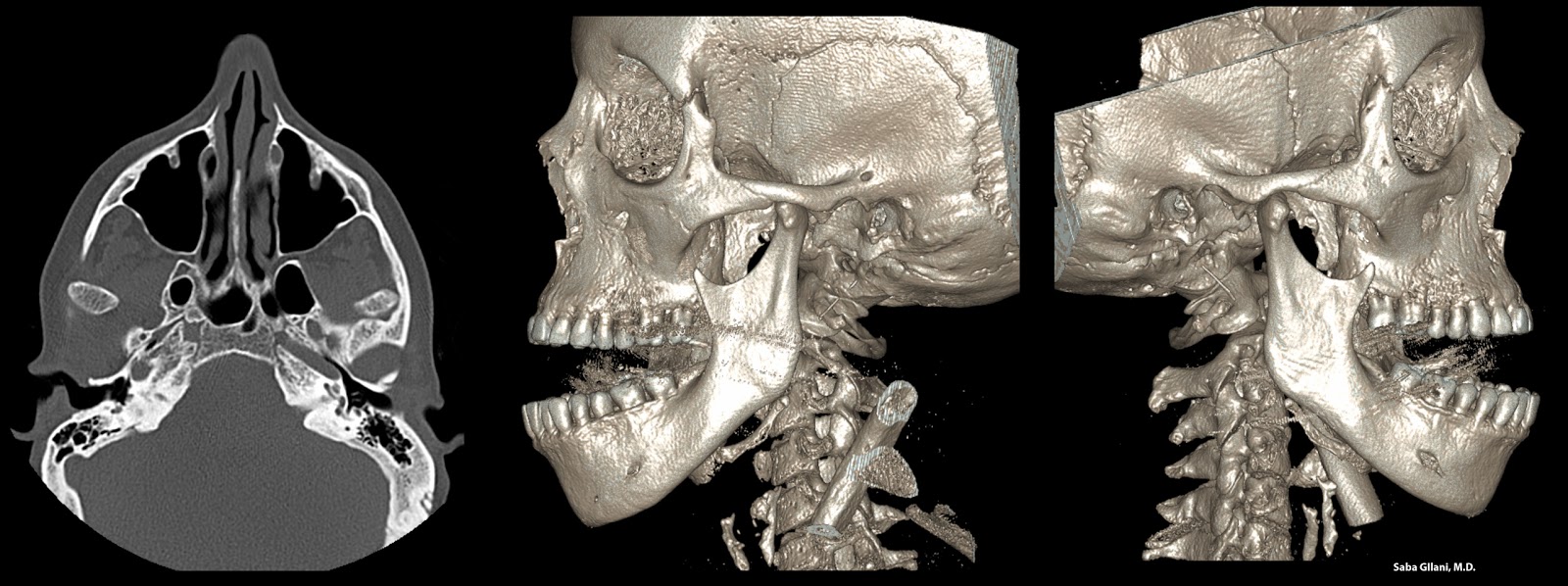 Roentgen Ray Reader: Internal Derangement of the Temporomandibular Joint