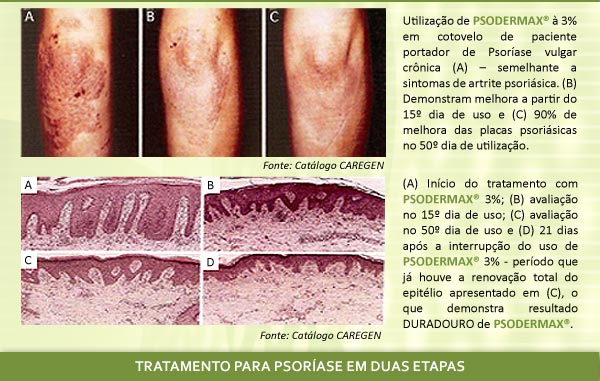 Farmatec: Psodermax, no controle e tratamento da Psoriase