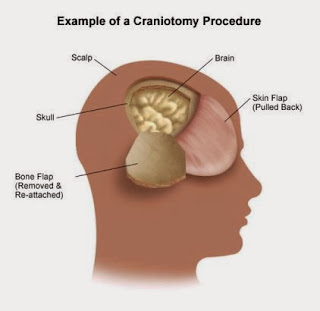 Craniotomy