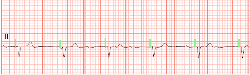 Basic EKG Rhythm Test 45