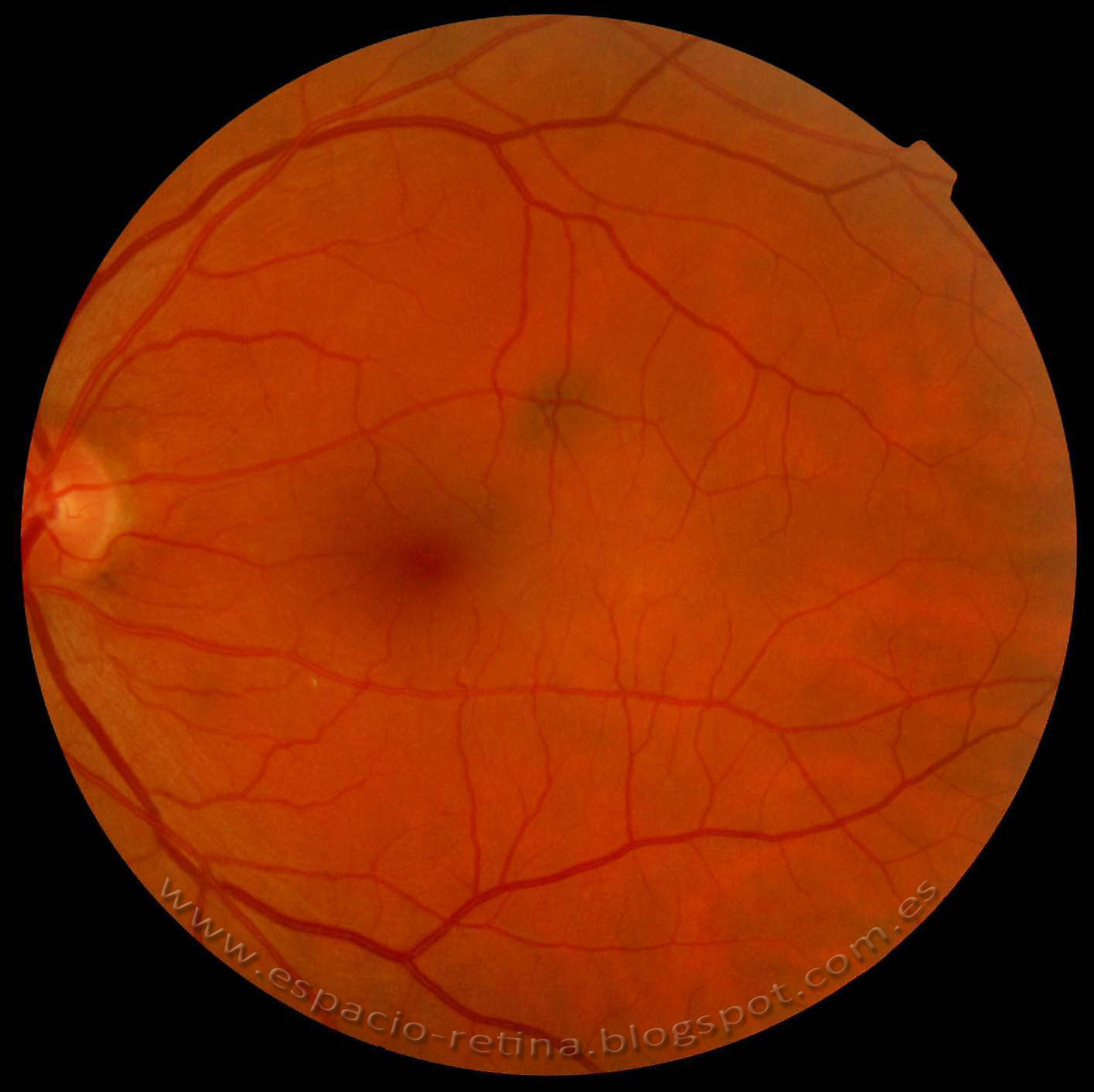 ESPACIO RETINA: Nevus.