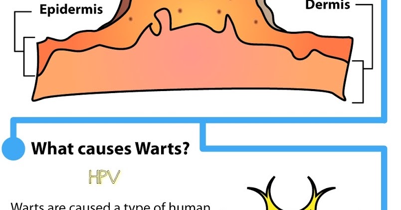 Warts: What They Are and How To Get Rid Of Them | Best Services Of ...