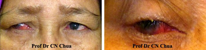 Eyelid Surgery by Prof Dr CN CHUA 蔡鐘能: Pain and Visual Loss from ...
