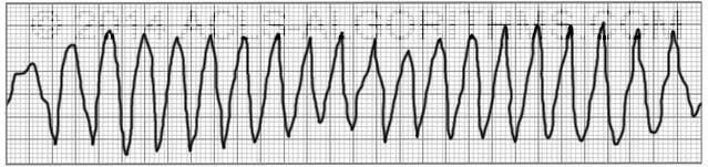 Polymorphic Ventricular Tachycardia | INA - ECG