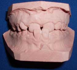 APARATOLOGIA ORTOPEDICA: PROGENIE