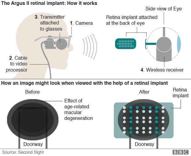 Bionic Eye Implant For Glaucoma - Procedure and Cost - Eye Vitamins ...