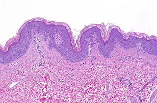 VIRTUAL GRAND ROUNDS IN DERMATOLOGY 2.0: Confluent and Reticulated ...