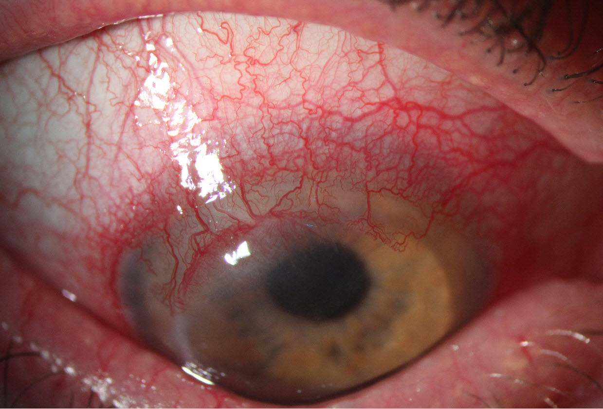 Journal and Conferences on Ophthalmology: Management of Corneal Graft ...