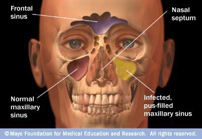 SINUSITE! COMO PREVENIR