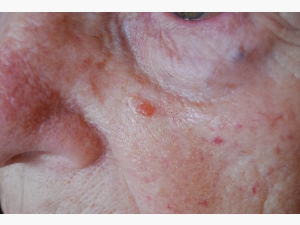 Dermpath Made Simple - Neoplastic: Sebaceous Tumours