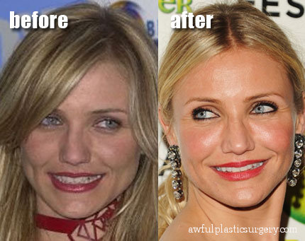 Cameron Diaz Plastic Surgery Before and After Nose job and Facelift ...