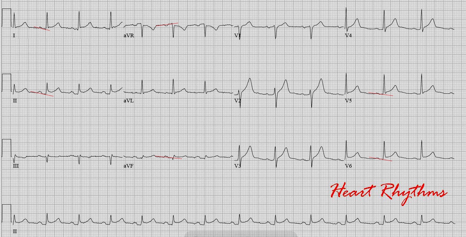 ECG Rhythms: Pericarditis