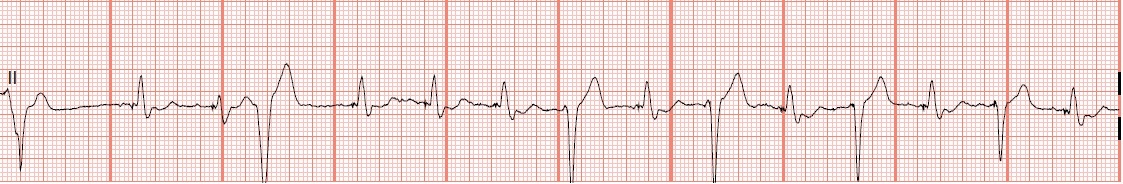 EKG Rhythm Strip Quiz 31