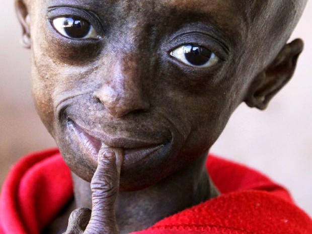 PROGERIA , Hutchinson-Gilford Progeria Syndrome or "HGPS" ~ Dr Impo