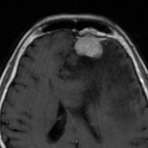 Neuroradiology Cases: Dural Tail Sign – Meningioma