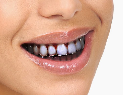 AFYA KWANZA!: ATHARI ZA KUPIGA MSWAKI MARA KWA MARA KWA KUTUMIA NGUVU.